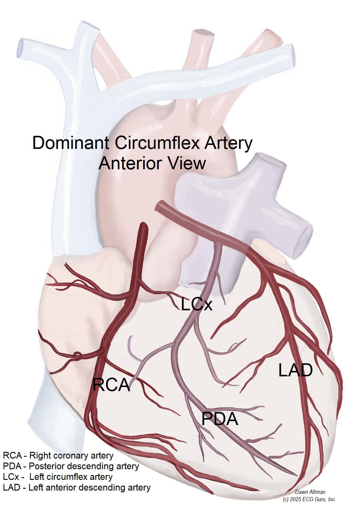 Illustration: Dominant left circumflex artery labelled; Dominant left circumflex artery | ECG ...